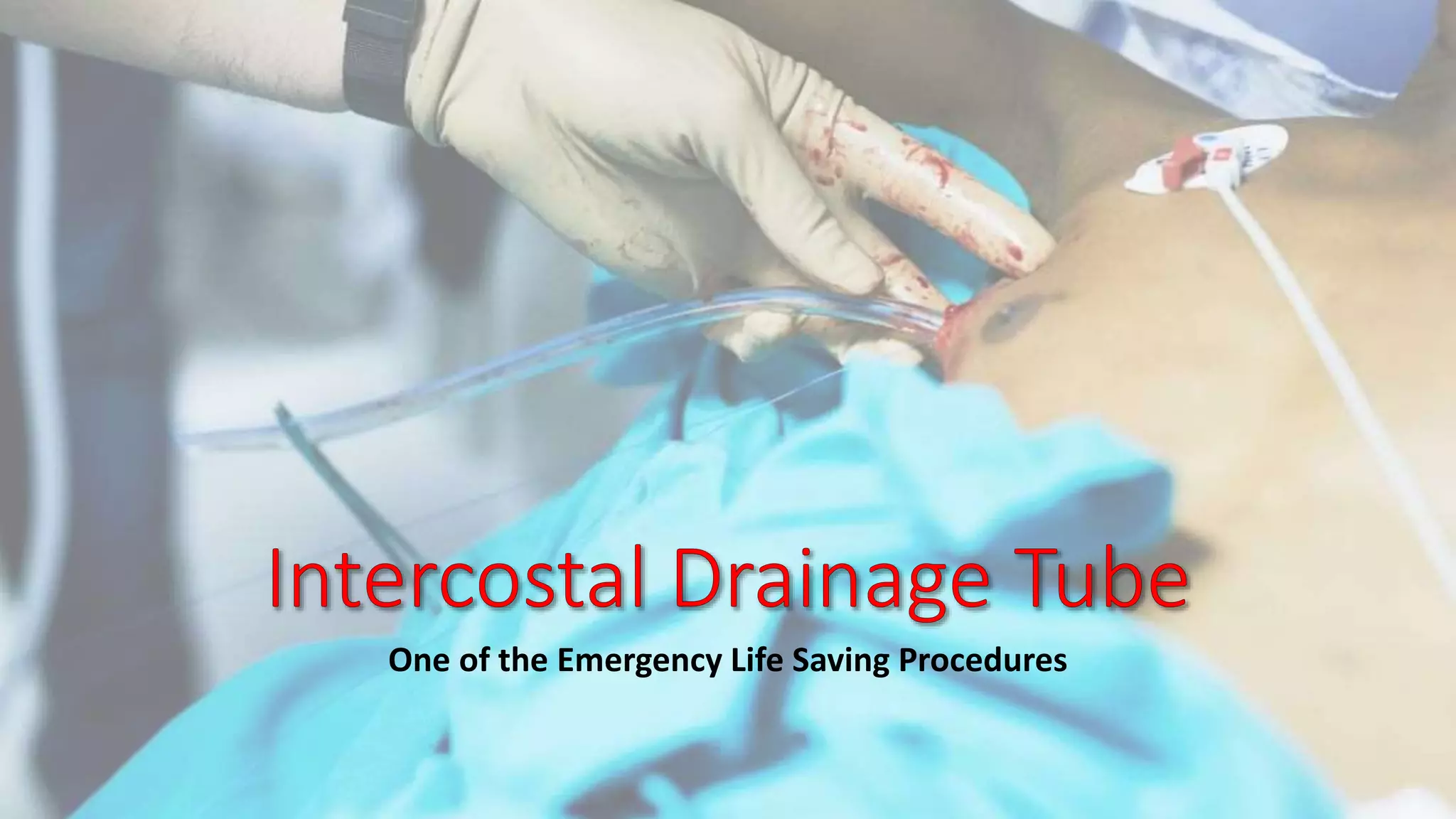 Intercostal Drainage Tube | PPTX