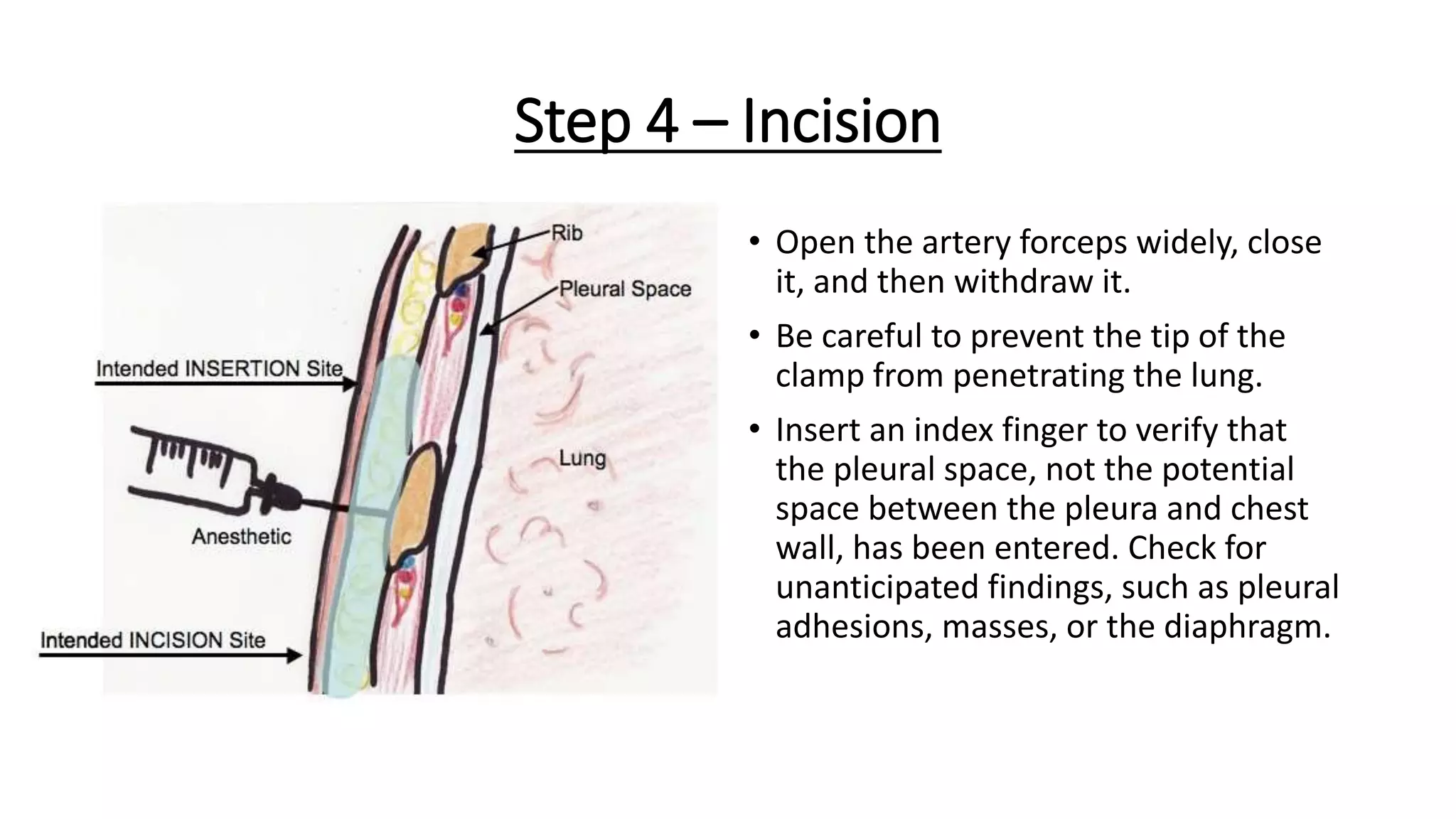 Intercostal Drainage Tube | PPTX
