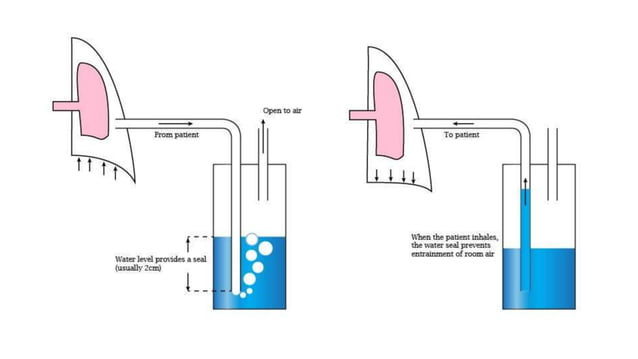 Intercostal Drainage Tube | PPTX