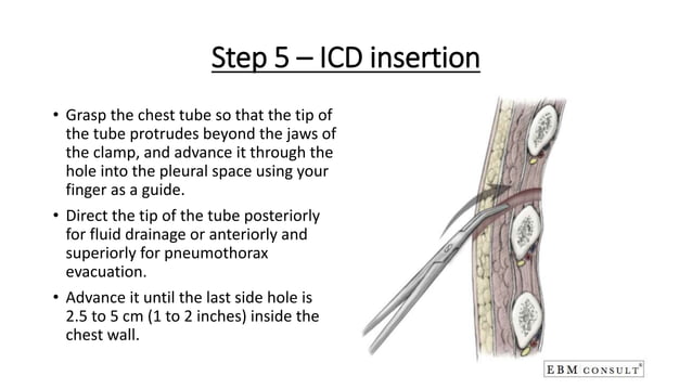 Intercostal Drainage Tube | PPTX