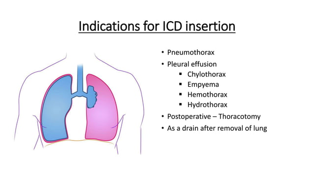Intercostal Drainage Tube