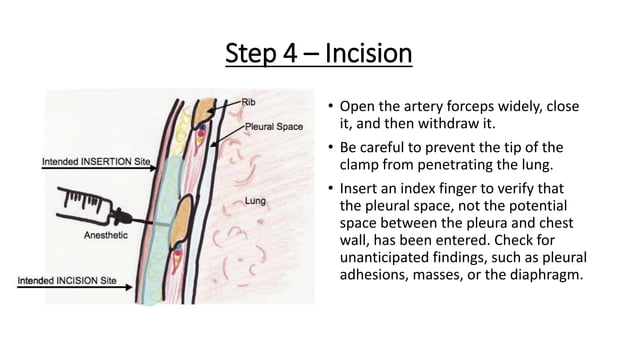 Intercostal Drainage Tube