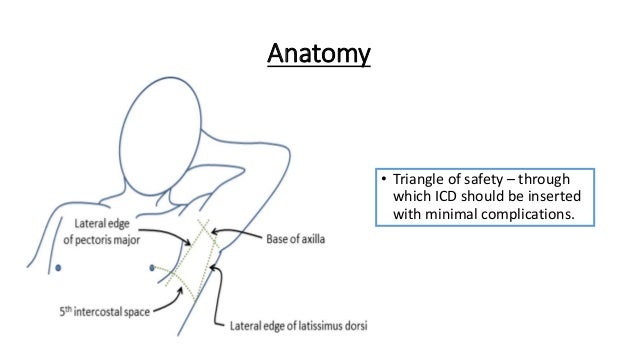 Intercostal Drainage Tube