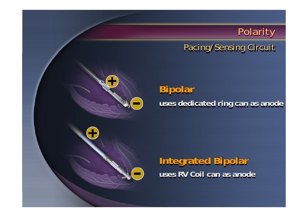 Basic ICD treatment_lecture