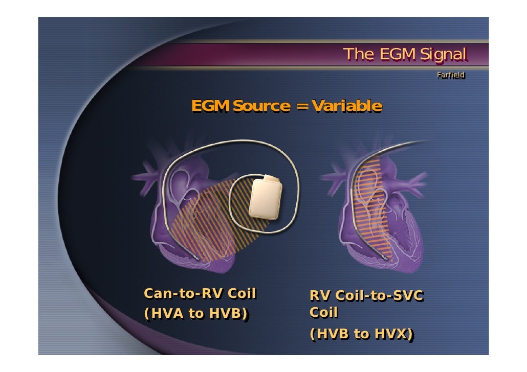 Basic ICD treatment_lecture