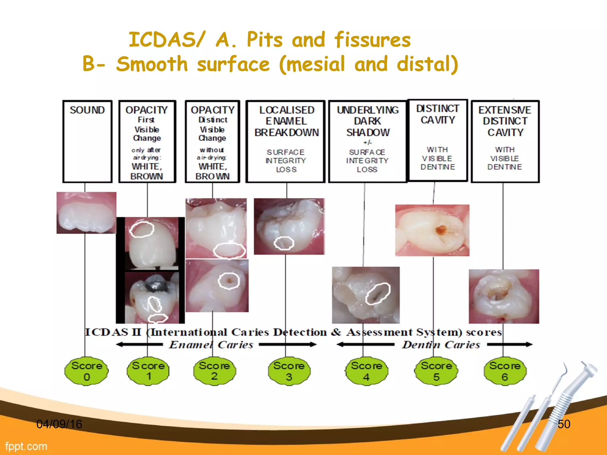 International Caries Detection and Assessment System (ICDAS) | PPT