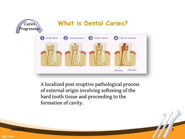 International Caries Detection and Assessment System (ICDAS) | PPT