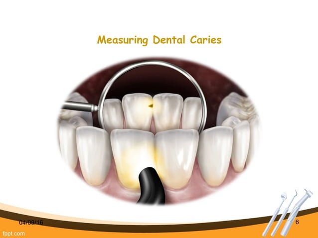 International Caries Detection and Assessment System (ICDAS) | PPT