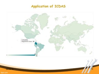 International Caries Detection and Assessment System (ICDAS) | PPT