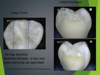 CRITERIOS ICDAS PARA DETECTAR CARIES DE ESMALTE Y DENTINA | PPT
