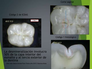 CRITERIOS ICDAS PARA DETECTAR CARIES DE ESMALTE Y DENTINA | PPT