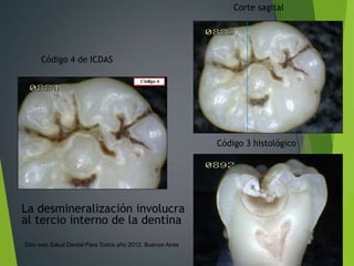 CRITERIOS ICDAS PARA DETECTAR CARIES DE ESMALTE Y DENTINA | PPT