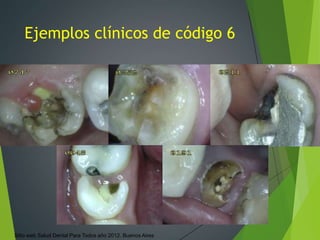 CRITERIOS ICDAS PARA DETECTAR CARIES DE ESMALTE Y DENTINA | PPT