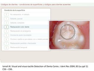 ICDAS -sistema internacional de detección y diagnostico de caries | PDF