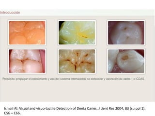 ICDAS -sistema internacional de detección y diagnostico de caries | PDF