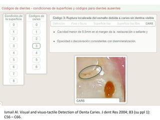 ICDAS -sistema internacional de detección y diagnostico de caries | PDF
