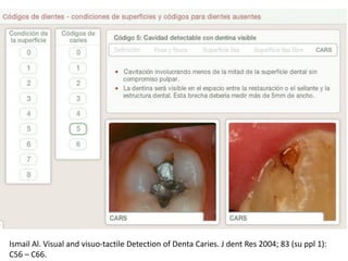 ICDAS -sistema internacional de detección y diagnostico de caries | PDF