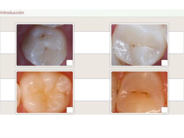 ICDAS -sistema internacional de detección y diagnostico de caries | PDF