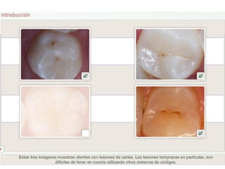 ICDAS -sistema internacional de detección y diagnostico de caries | PDF