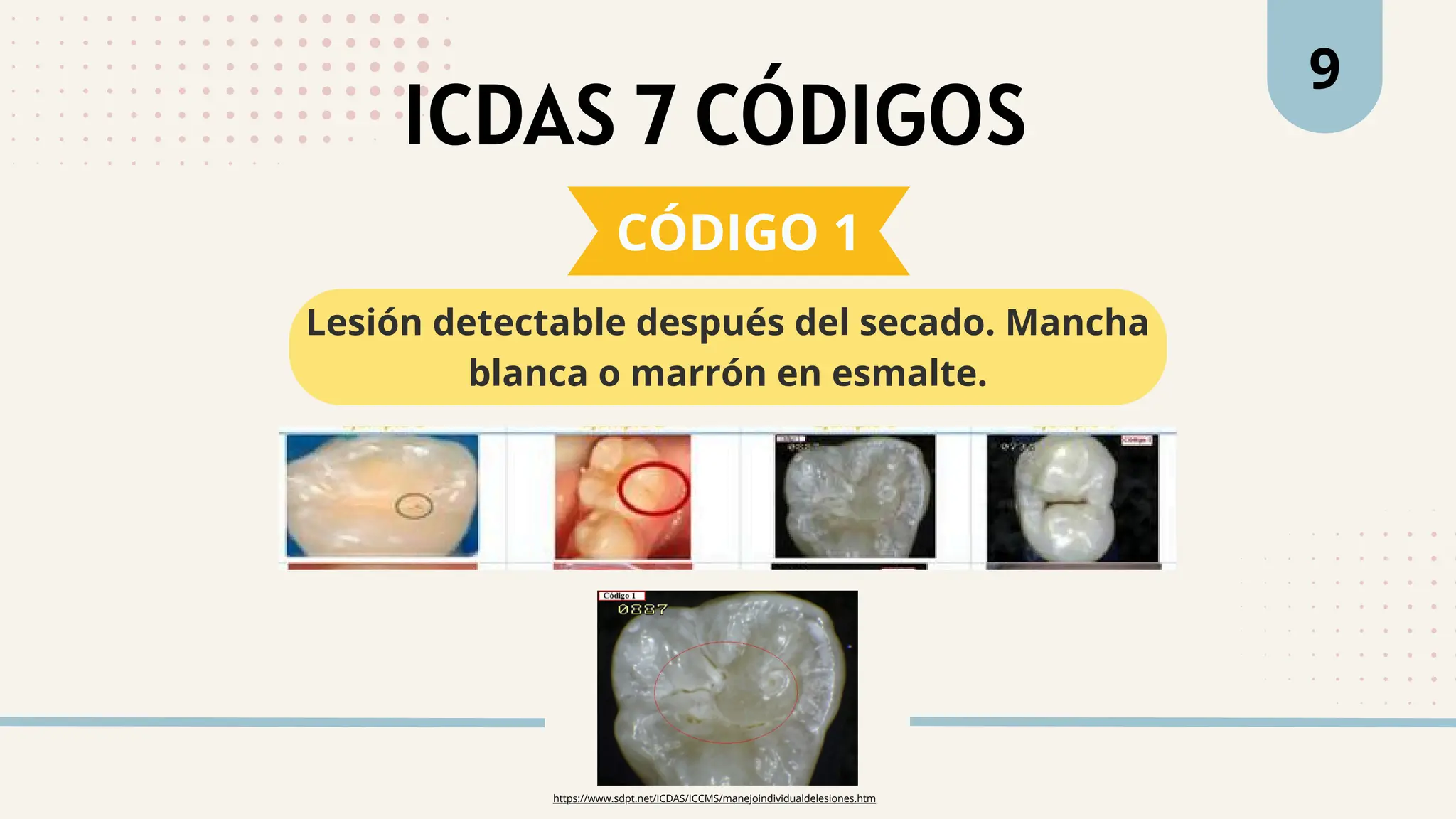 criterios ICDAS, cariologia, avance de las caries .pdf