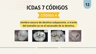 criterios ICDAS, cariologia, avance de las caries .pdf