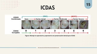 criterios ICDAS, cariologia, avance de las caries .pdf