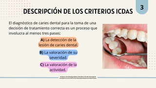 criterios ICDAS, cariologia, avance de las caries .pdf