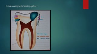 Icdas caries ppt | PPTX