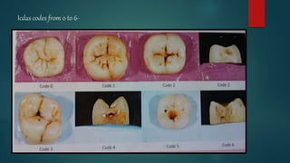 Icdas caries ppt | PPTX