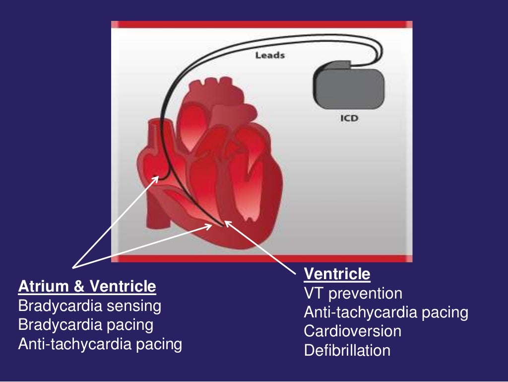 Implantable Cardioverter Defibrillator Scar