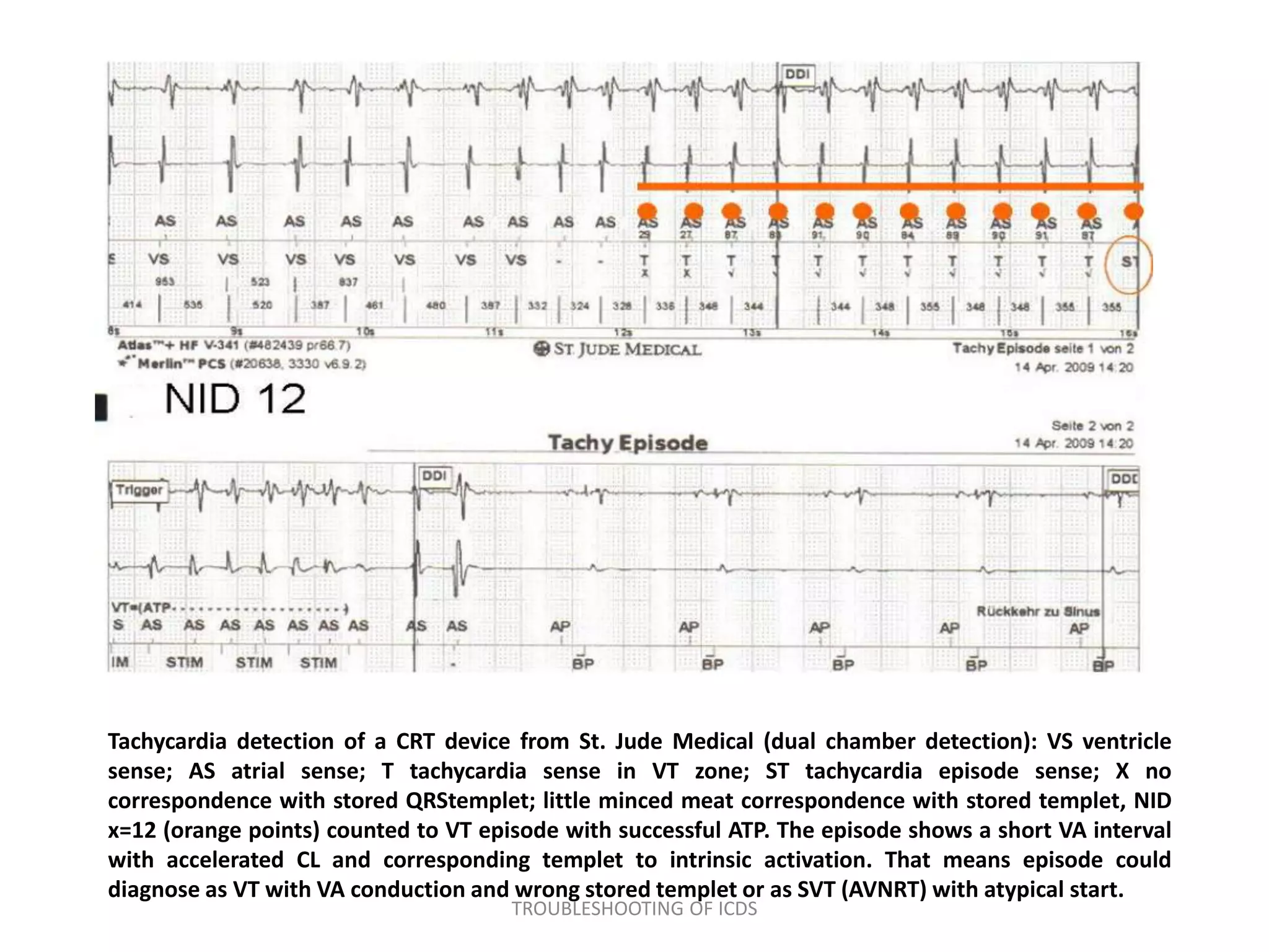 Tachycardia discriminating algorithms and trouble shooting of ICDs | PPTX