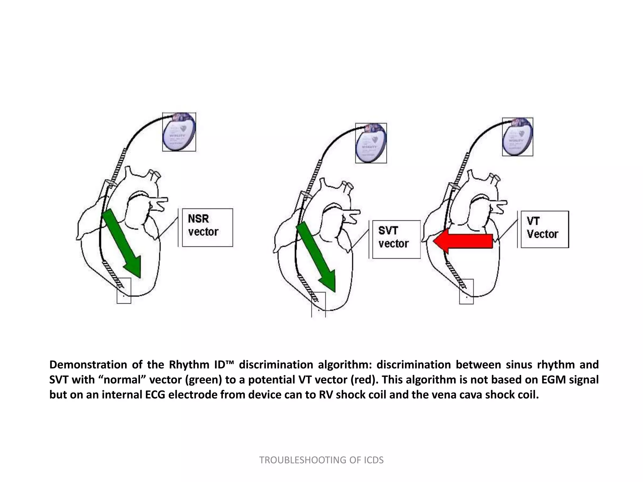Tachycardia discriminating algorithms and trouble shooting of ICDs | PPTX