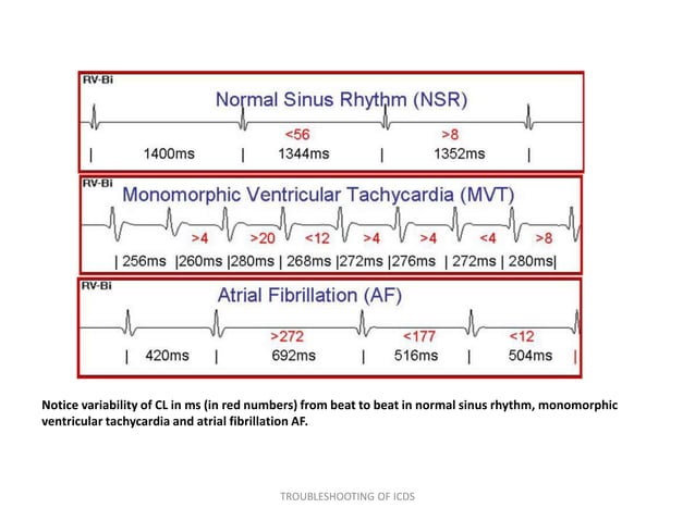Tachycardia discriminating algorithms and trouble shooting of ICDs | PPTX