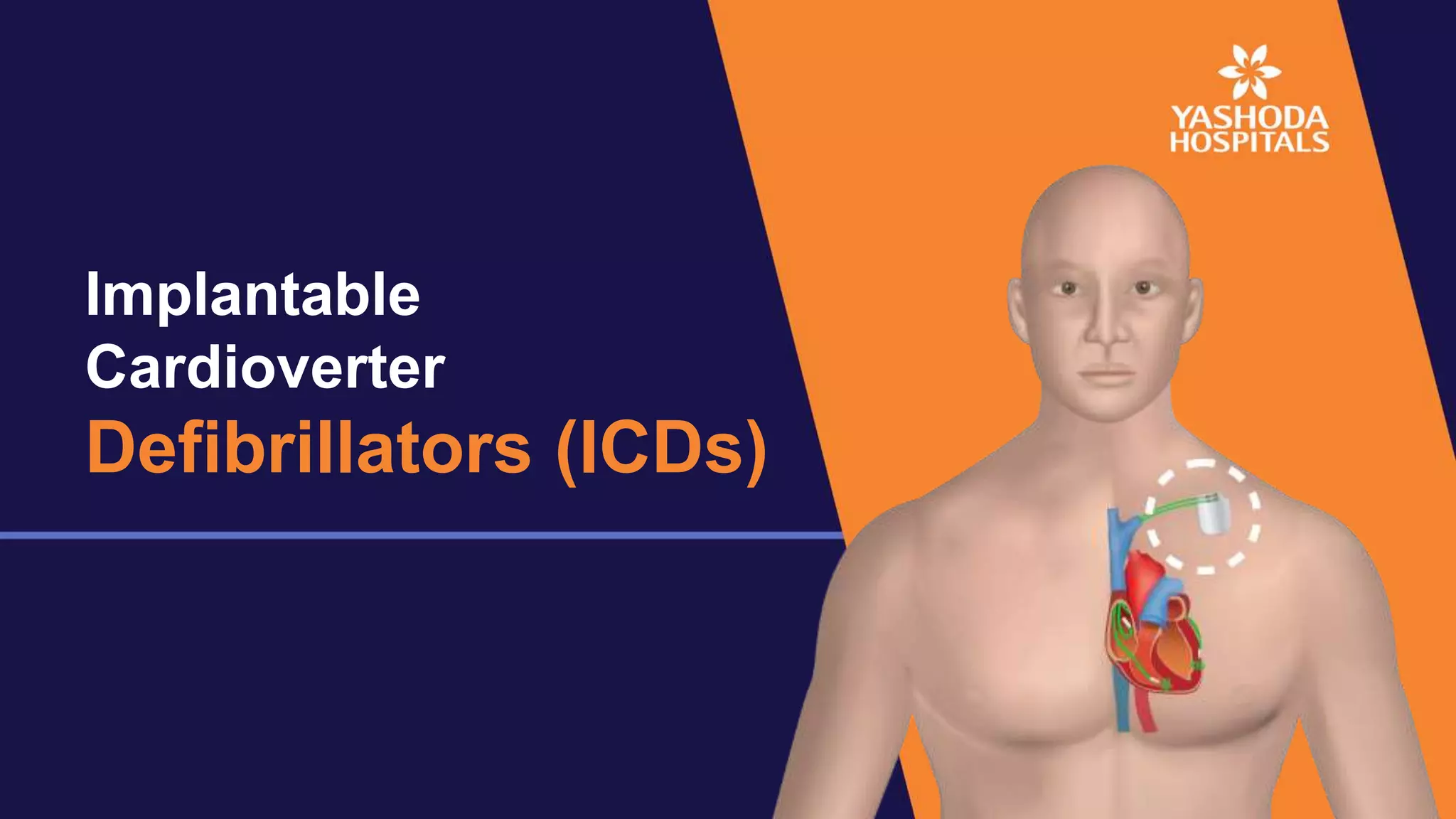 Implantable Cardioverter Defibrillators -ICD | PPTX