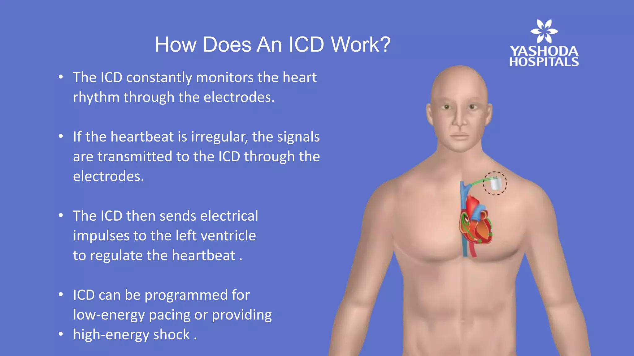 Implantable Cardioverter Defibrillators -ICD | PPTX