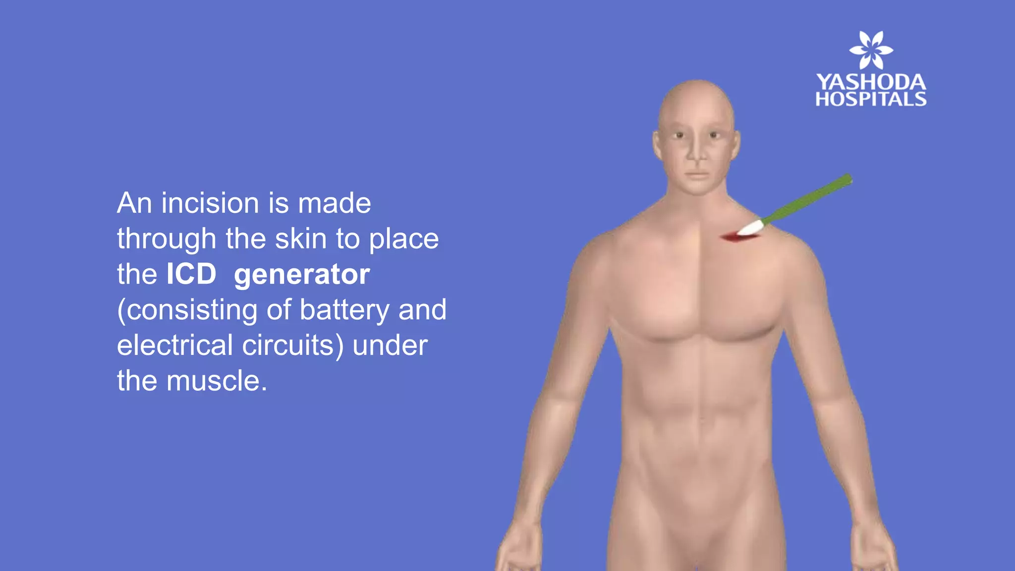 Implantable Cardioverter Defibrillators -ICD | PPTX