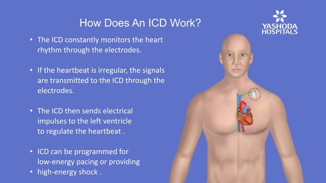Implantable Cardioverter Defibrillators -ICD | PPTX