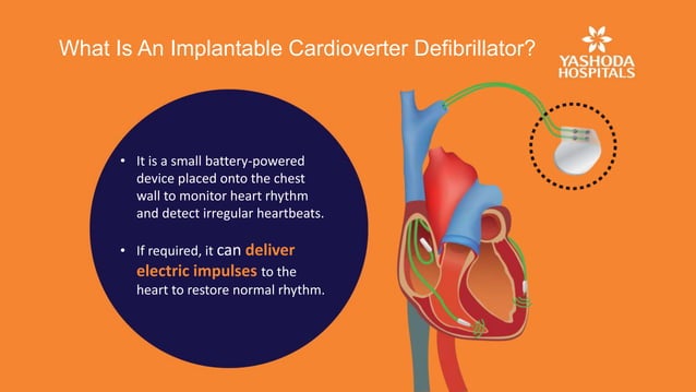 Implantable Cardioverter Defibrillators -ICD | PPTX