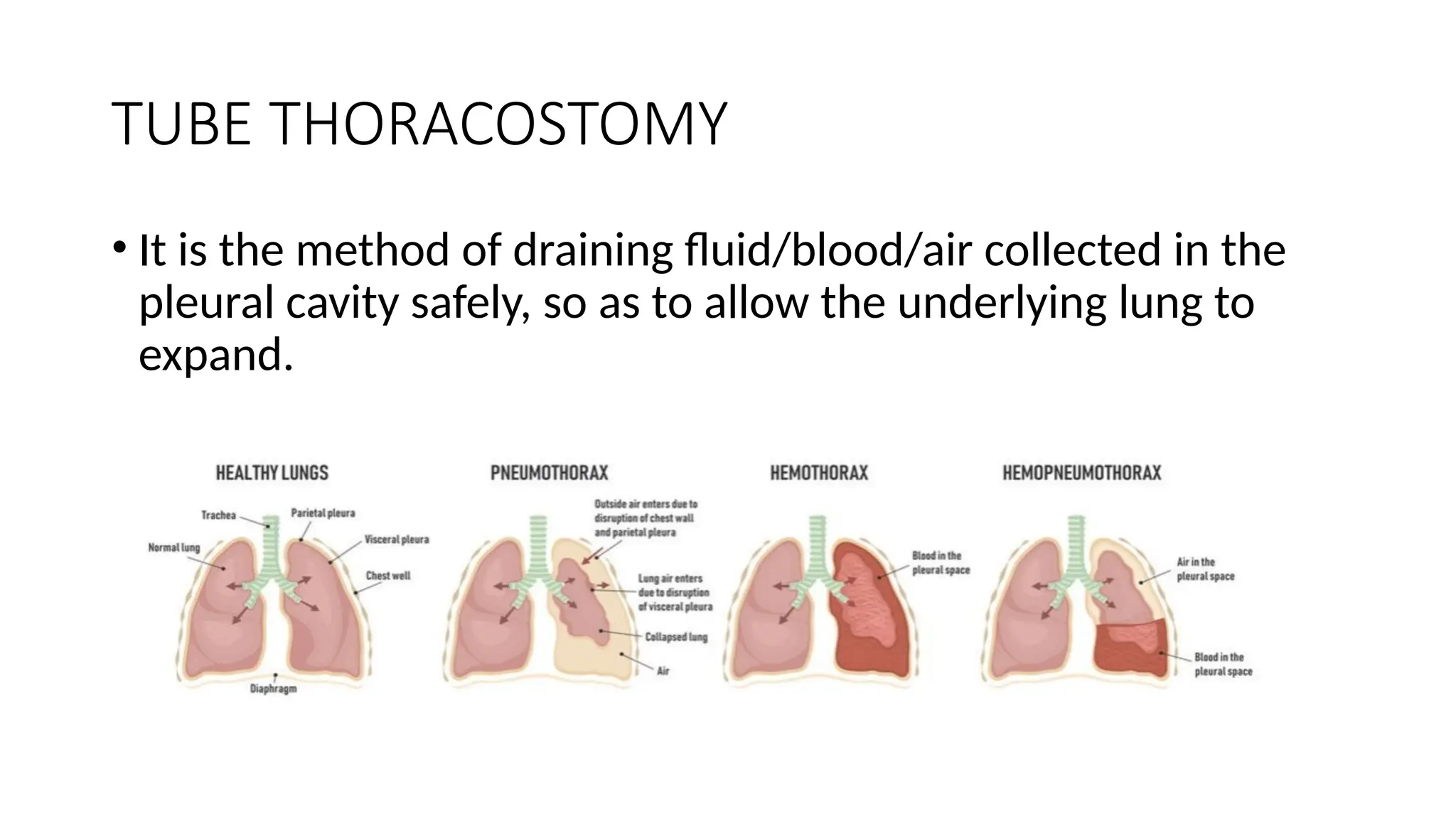 icd + tube thoracostomygydsfgfysadyfasftasdfasytgfs | PPTX | Death ...