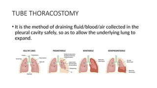 icd + tube thoracostomygydsfgfysadyfasftasdfasytgfs | PPTX