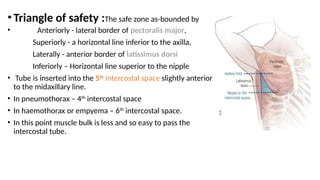 icd + tube thoracostomygydsfgfysadyfasftasdfasytgfs | PPTX | Death ...