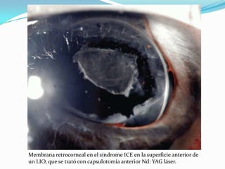 Síndrome iridocorneal endotelial | PPTX