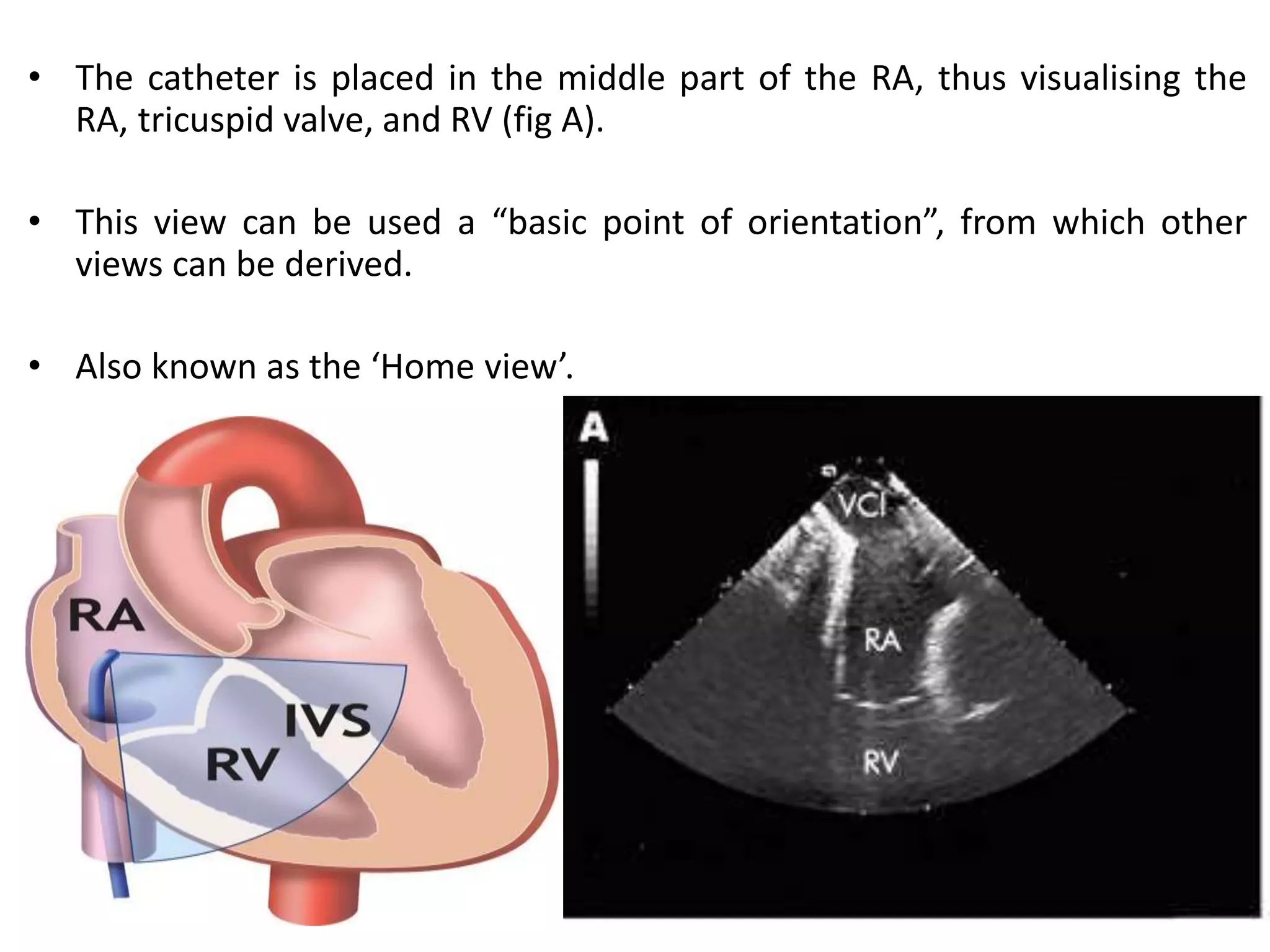 INTRACARDIAC ECHOCARDIOGRAPH (ICE) | PPTX