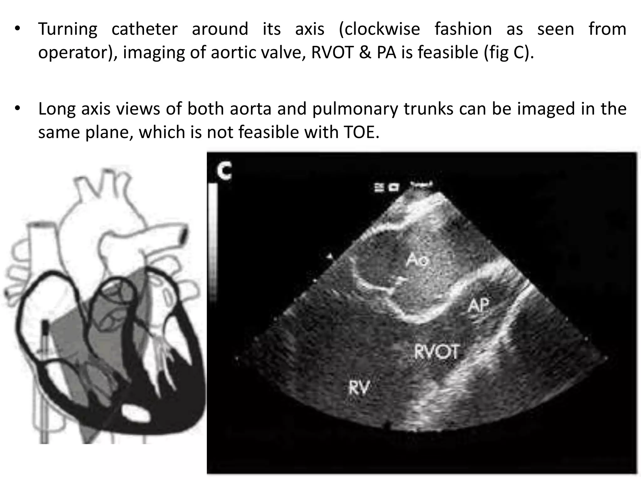 INTRACARDIAC ECHOCARDIOGRAPH (ICE) | PPTX