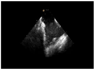 INTRACARDIAC ECHOCARDIOGRAPH (ICE) | PPTX