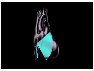 INTRACARDIAC ECHOCARDIOGRAPH (ICE) | PPTX