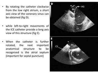 INTRACARDIAC ECHOCARDIOGRAPH (ICE) | PPTX