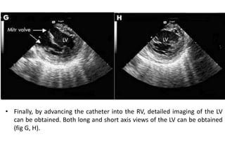 INTRACARDIAC ECHOCARDIOGRAPH (ICE) | PPTX