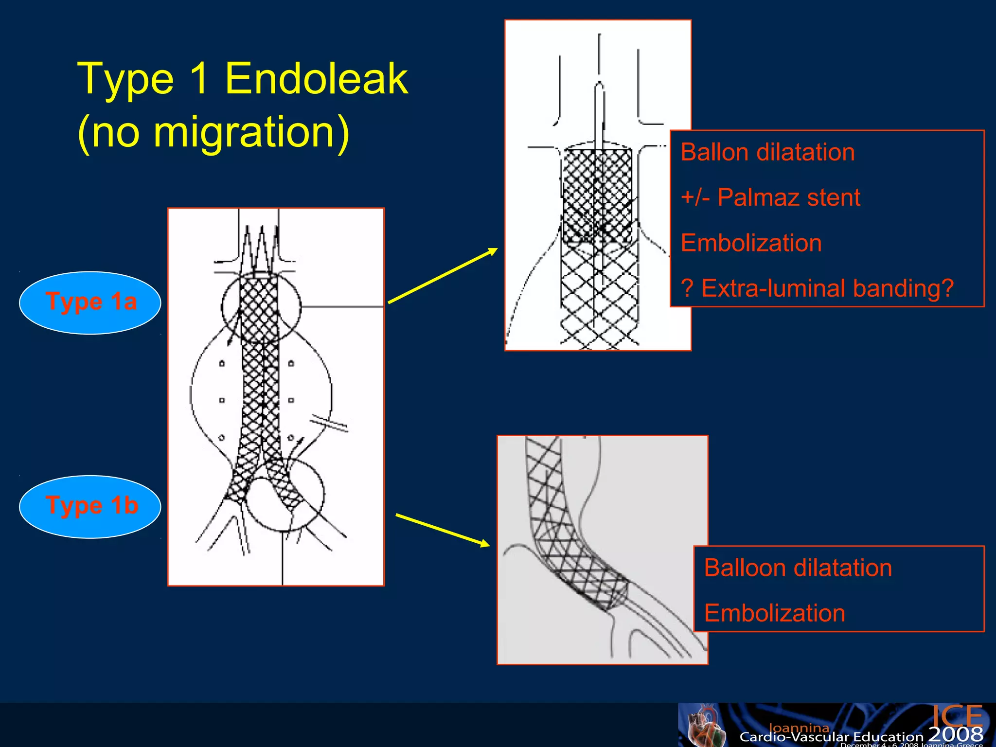 Endoleaks 1, 3 | PPT