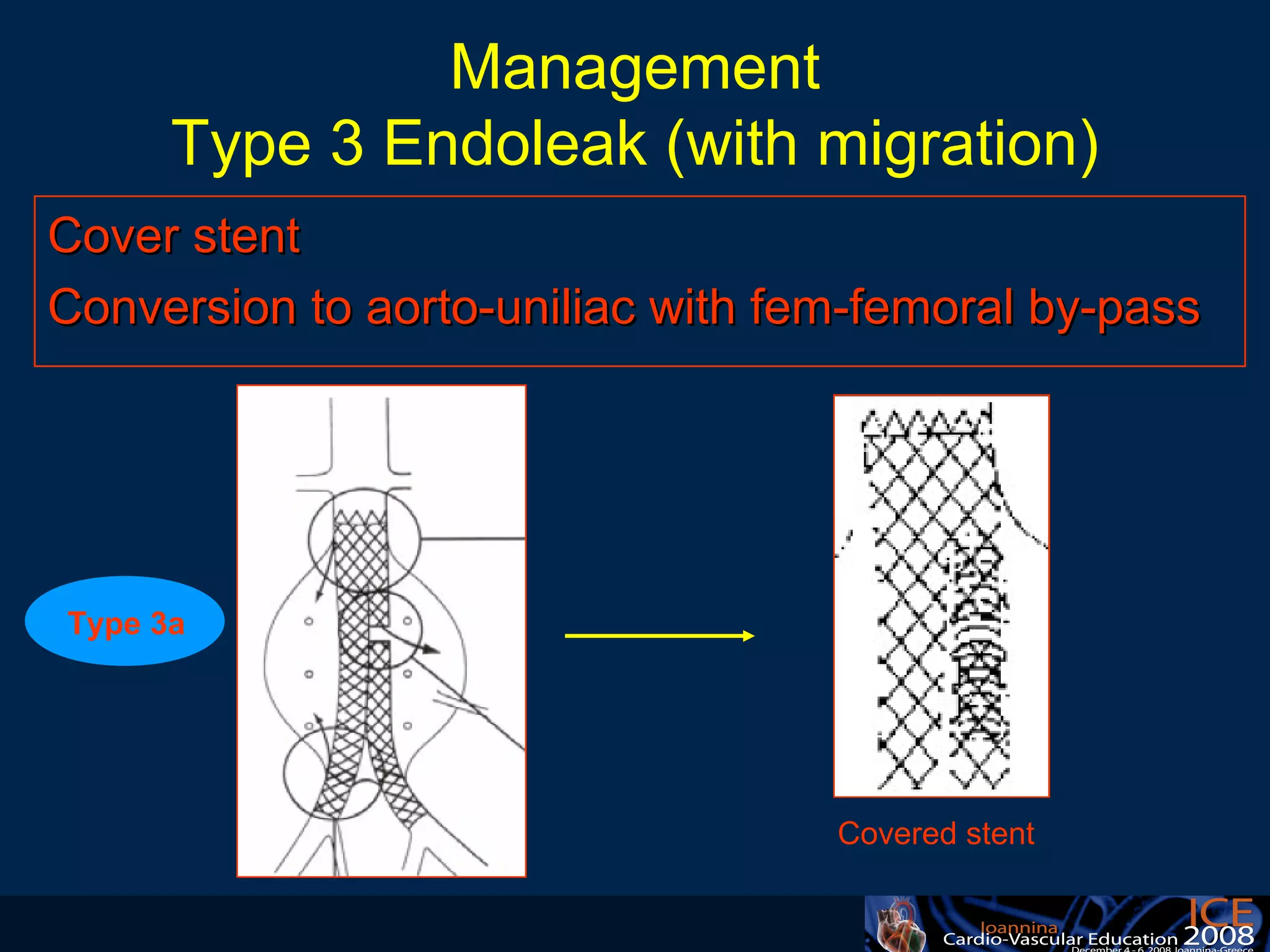 Endoleaks 1, 3 | PPT